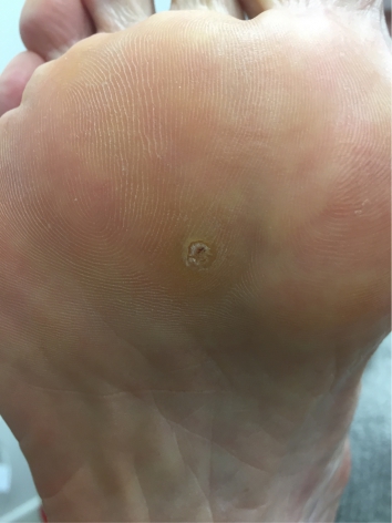 PLANTAR WARTS - First in Feet